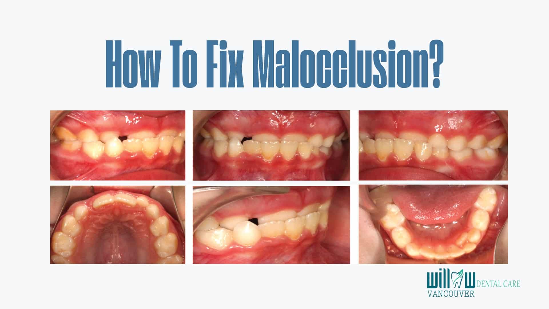 How to Fix Malocclusion: Effective Treatments for a Healthier Smile